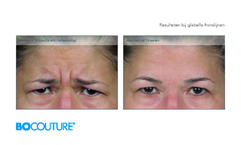 Welke botox zones zijn er? - VIA Clinic